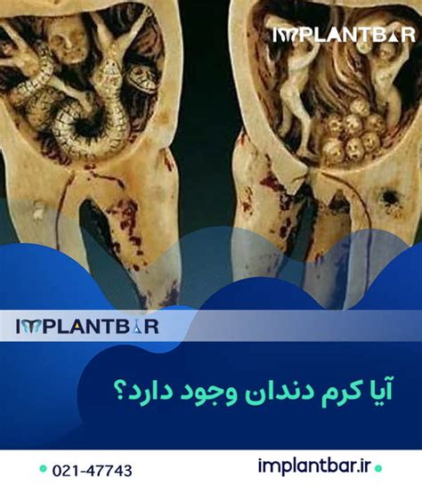 کرم دندان چیست؟ واقعیت یا افسانه؟ ایمپلنت بار