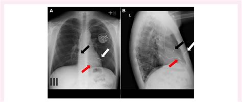 Left Sided Infraclavicular Dual Chamber Pacemaker With Implantable Loop Download Scientific