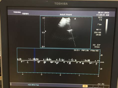 Toshiba Pvt 674bt Convex Array Transducer Ultrasound Probe For Aplio Xg Auschoice