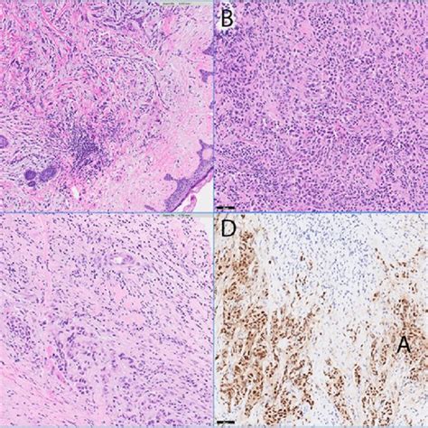Three Cases With High Tumor Mutation Burden A C Representative Hande Download Scientific Diagram