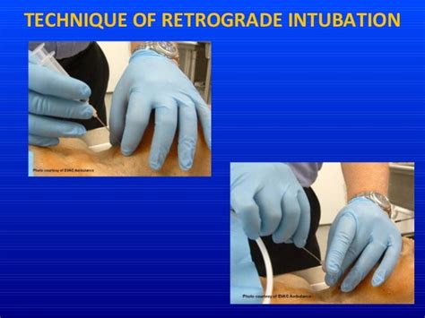 Alternative Technique Of Intubation Retromolar Retrograde Submental…