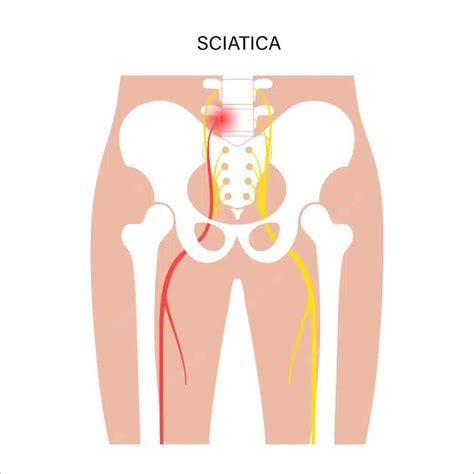 What Is Sciatic Nerve Compression