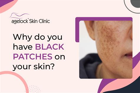 Why Do You Have Black Patches On Your Skin Agelock Skin Clinic