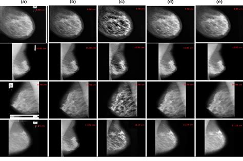 Figure 1 From An Automatic Detection And Localization Of Mammographic Microcalcifications Roi