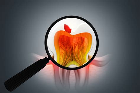 충 치 치아 구멍이 닫히고 치아의 단면을 가진 돋보기를 보여주는 충치 3d 그림 돋보기 광학 기기에 대한 스톡 사진 및 기타