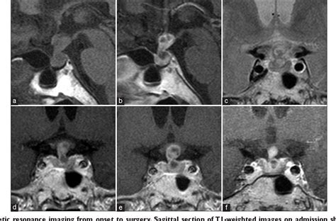 Figure 1 From Xanthomatous Hypophysitis Associated With Autoimmune Disease In An Elderly Patient