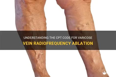 Understanding The Cpt Code For Varicose Vein Radiofrequency Ablation Medshun