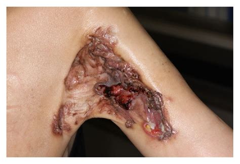 Giant Muscle Invasive Dermatofibroma Clinically Mimicking A Malignant