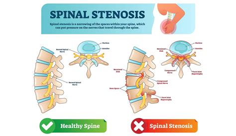 Spinal Stenosis Trimed Spine And Joint