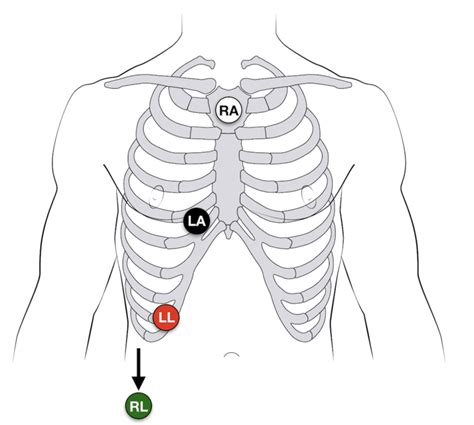 Emergency Medicine Educationecg Pointers The Lewis Lead