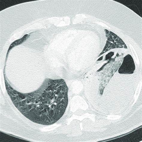 Ct Chest With Contrast Shows Left Sided Pulmonary Filling Defect