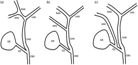 Aberrant Right Posterior Sectoral Duct Injury Necessitating Liver