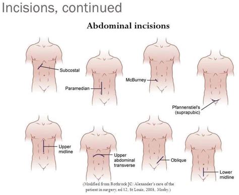 Best Incision For C Section At Bradley Briseno Blog