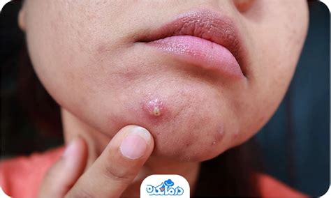 جوش زیر پوستی علت، پیشگیری و درمان سریع بهترین پماد