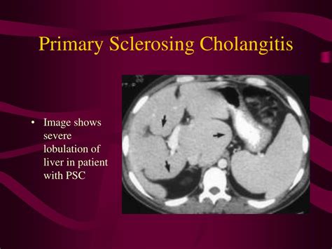 Ppt Radiographic Findings In Ulcerative Colitis And Crohn Disease Powerpoint Presentation Id