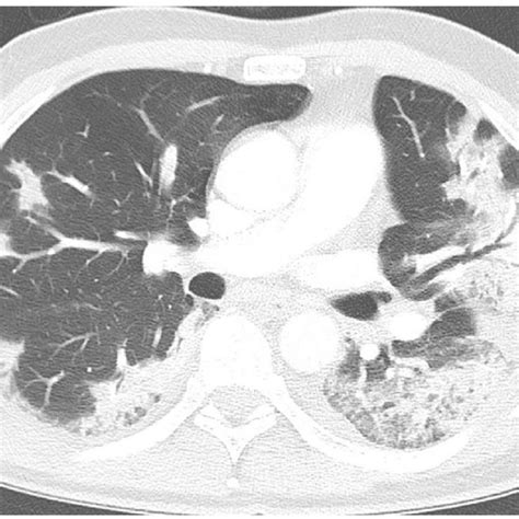 Ctpa Showing Multiple Bilateral Segmental Pulmonary Emboli Download Scientific Diagram