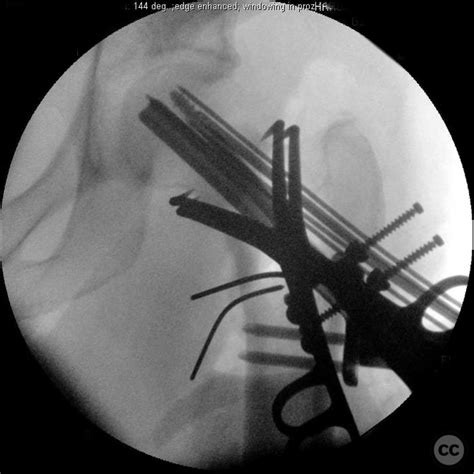 Vertical Displaced Femoral Neck Fracture
