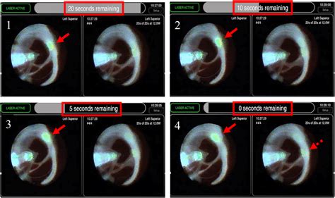 Endoscopic Image Of The Dragging Movement Of The Target Marker During