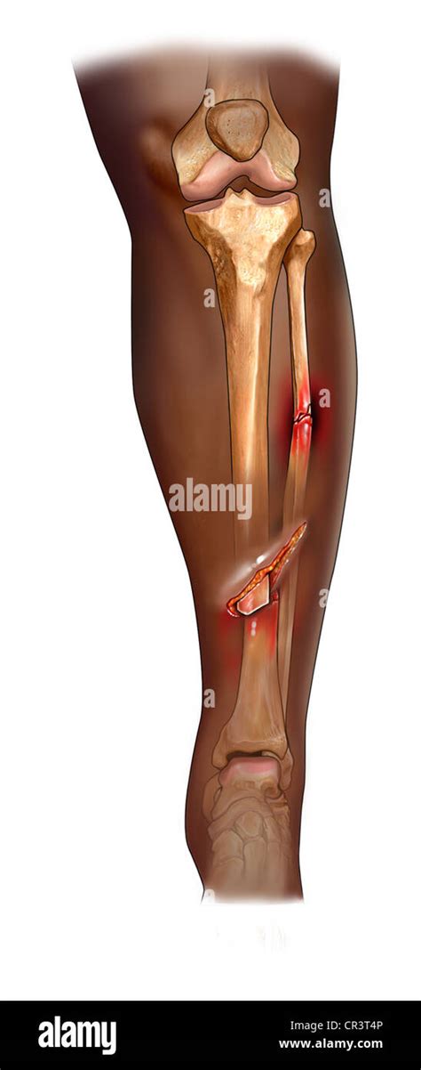 Open Tibia Fracture