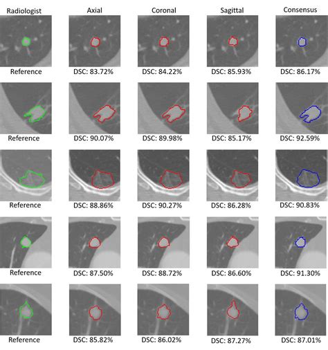 Volumetric Lung Nodule Segmentation Using Adaptive Roi With Multi View Residual Learning Deepai
