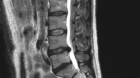 Can Spinal Decompression Help Herniated Discs Ireland 2023