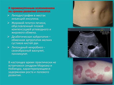 Сахарный диабет - презентация онлайн