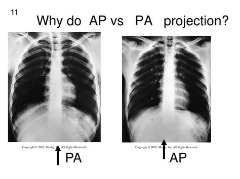 Ppt Pa Anterior Side Best Seen Ap Posterior Side Best Seen Powerpoint Presentation Id 3207266