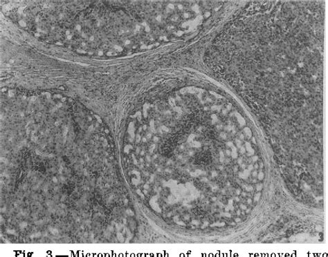 Hypodermal Myiasis Caused By Larvae Of The Ox Warble Hypoderma Bovis Semantic Scholar