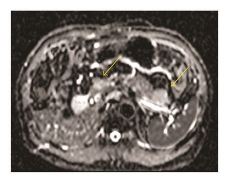 Magnetic Resonance Imaging Sections Of Pancreas Tumors Pancreatic Download Scientific Diagram