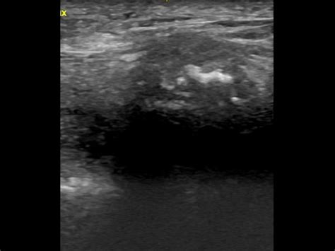 Calcaneus Orif With Failed Hardware Affecting Fibularis Tendons Ultrasound Cases