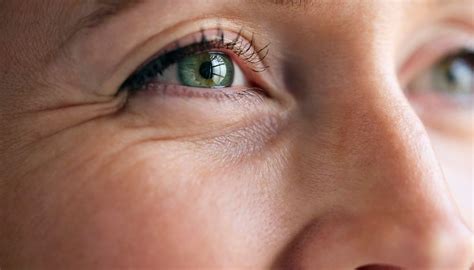 How To Get Rid Of Crows Feet Eyes Causes And Treatments