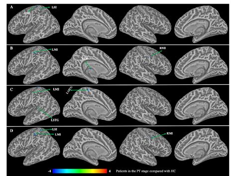 Gray Matter Of Left Anterior Cingulate Gyrus Semantic Scholar