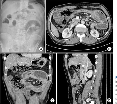 [pdf] Robotic Assisted Resection Of Proximal Jejunal Ischemic Stricture And Intracorporeal Robot