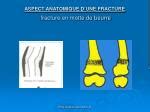Ppt Les Fractures Powerpoint Presentation Id 299150