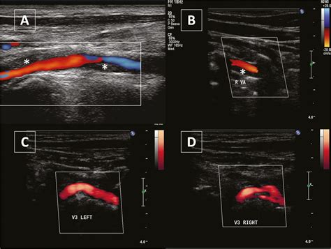 Cervical Artery Dissection Neupsy Key