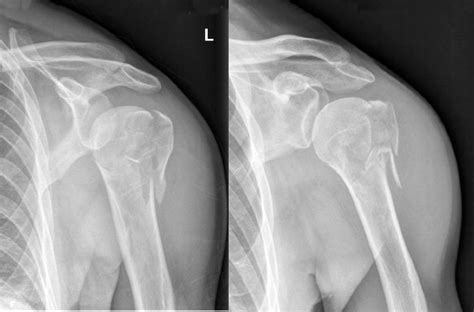 Proximal Humerus Fracture Adult Hand Surgery Resource