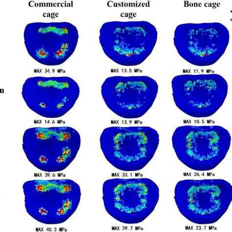 3d View Of Implants Used In Acdf Models A Acdf Model And B Three Download Scientific