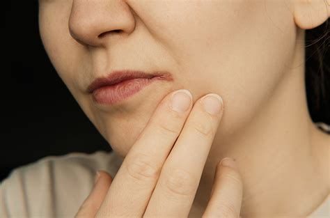 Angular Cheilitis Gejala Penyebab Dan Cara Mengatasi