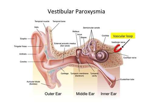 Vestibular Paroxysmia Vascular Loop Syndrome