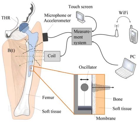 Schematic Illustration Of The Passive Sensor Array Inside A Total Hip Stem Download
