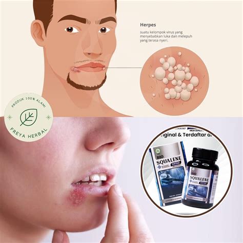 Jual Obat Herpes Obat Herbal Simplex Obat Herpes Zoster Obat Herpes