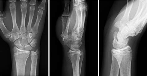 Figure 5 From Fracture Dislocation Of The Pisiform Bone In 14 Year Old
