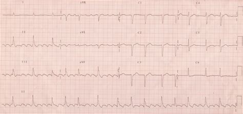 Atypical Atrial Flutter