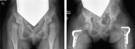 Preoperative And Postoperative Radiographs For Case Download Scientific Diagram