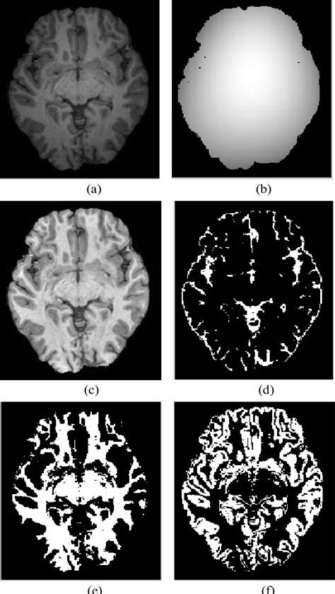 Figure 4 From An Mr Image Segmentation Algorithm Based On Bias Field Correction Semantic Scholar