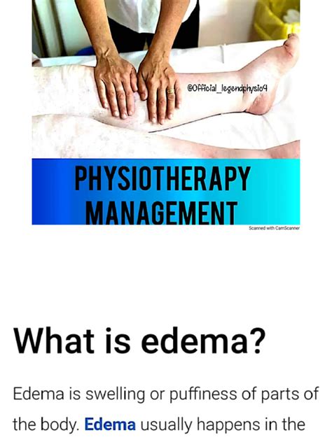 Edema With Physiotherapy Management Pdf