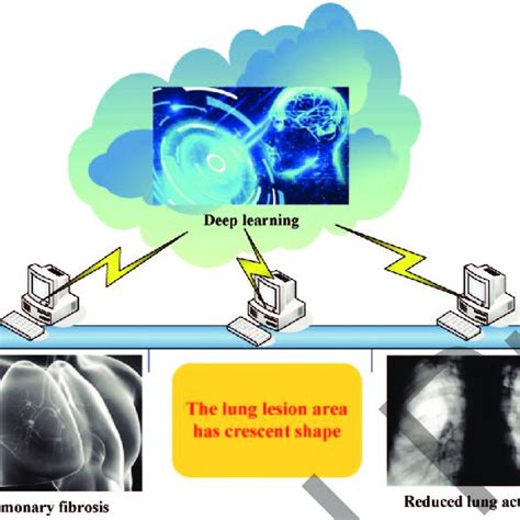 Pdf Application Of Medical Image Detection Technology Based On Deep Learning In Pneumoconiosis