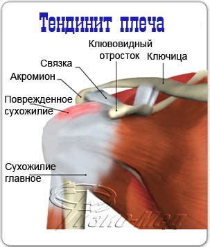 Тендинит: Причины,Симптомы,Лечение