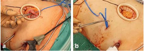 Diverting Loop Ileostomy