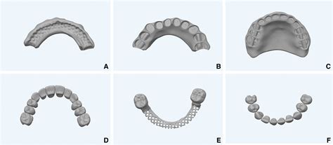 A Completely Digital Workflow For A Maxillary Tooth Supported Complete